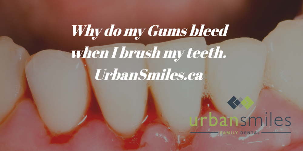 Why Do My Gums Bleed When I Brush My Teeth? - Urban Smiles Edmonton Dentist